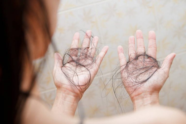Alopecia Stress | What is it? Symptoms | MyCapil 磊磊