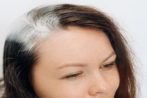 Poliosis or White Streak in the Hair - MyCapil ️
